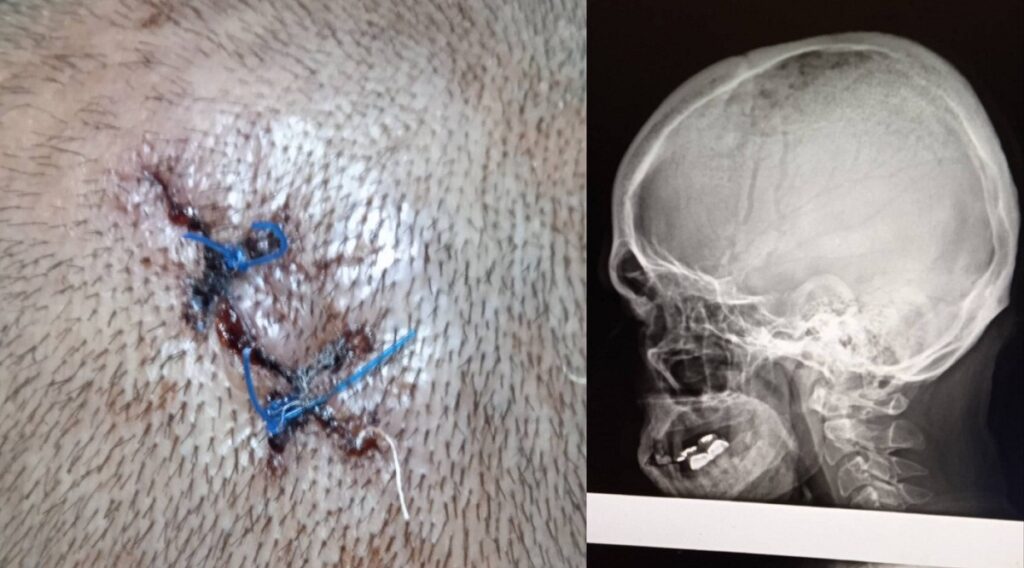 Violencia en Cuba: Joven recibe un batazo en la cabeza en asalto